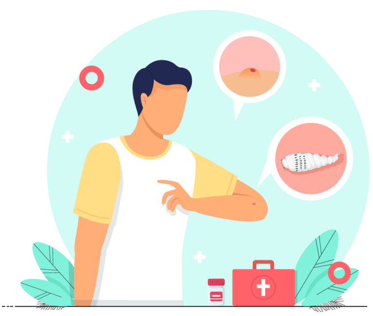 Myiase cutanée et sous cutanée : symptômes, traitements, prévention,...